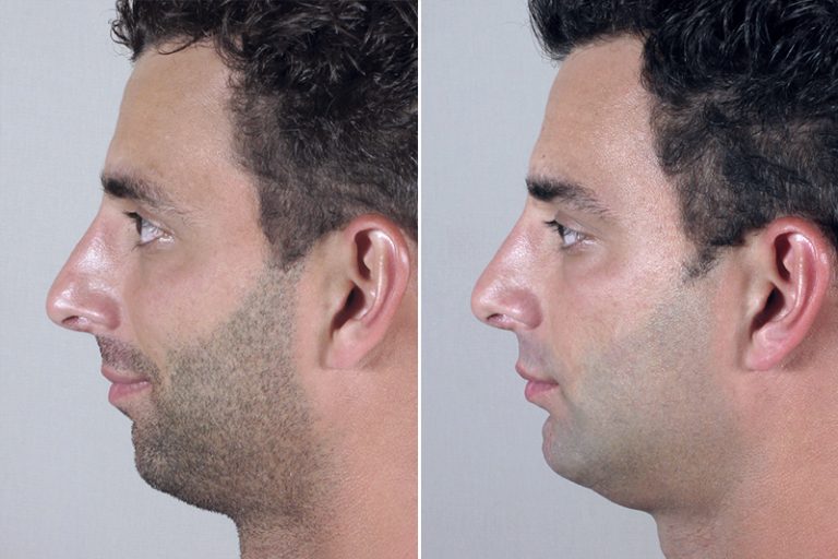 Male Chin Augmentation in Paramus, NJ – Parker Center for Plastic Surgery